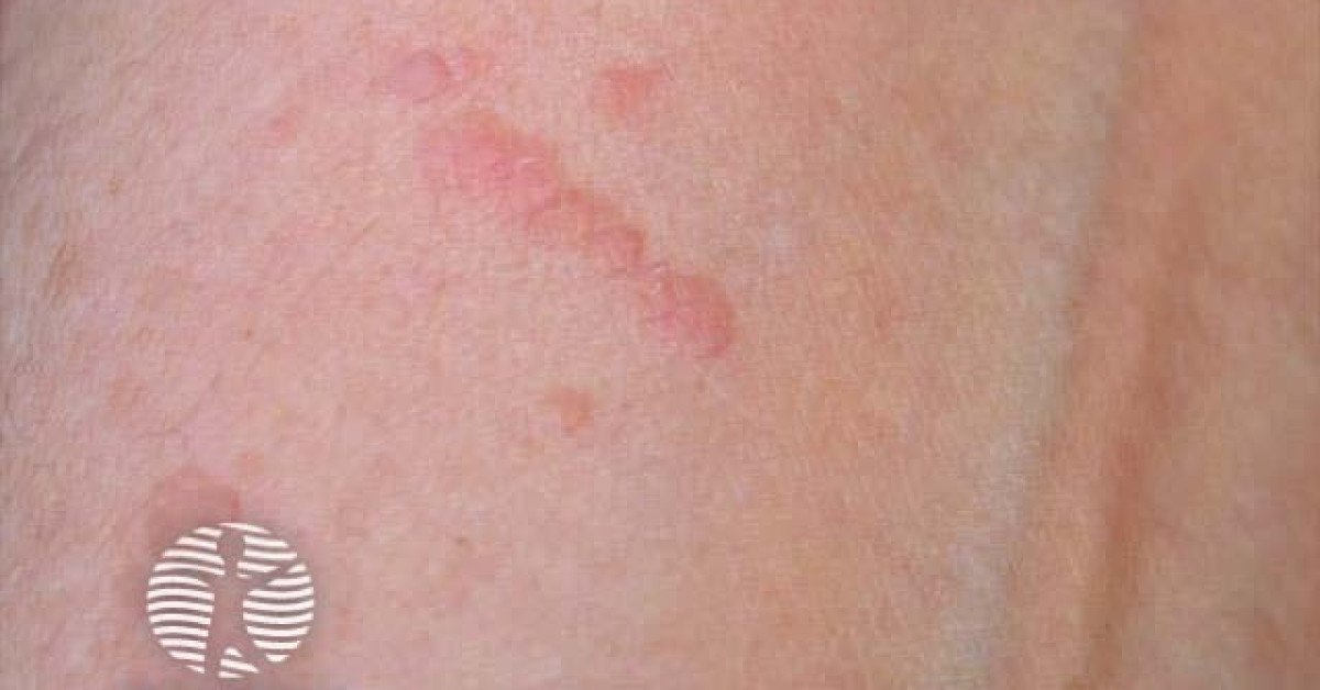 Koebnerised plane wart image