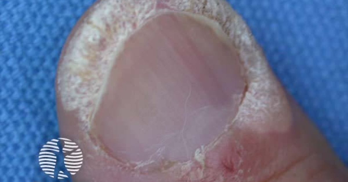 Periungual warts image