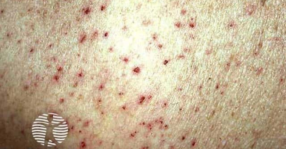 DermNet® - Excoriations image