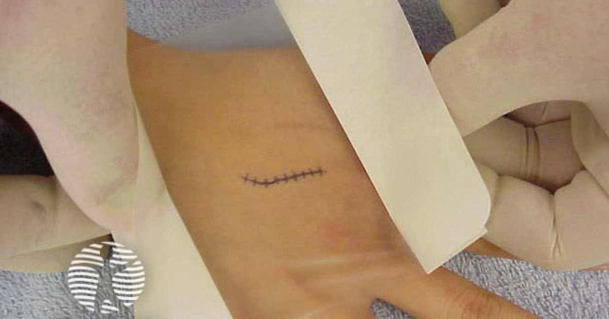 Opsite film dressing image