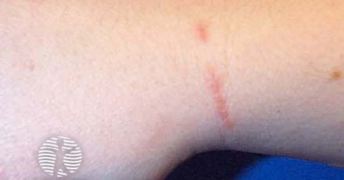 Koebner phenomenon: eczema image