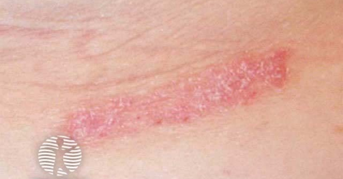 Koebner phenomenon: psoriasis image