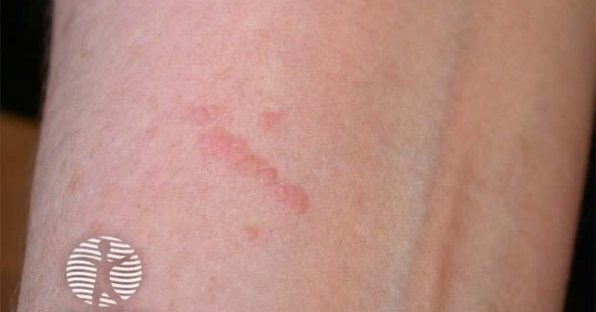 Koebner phenomenon: warts image