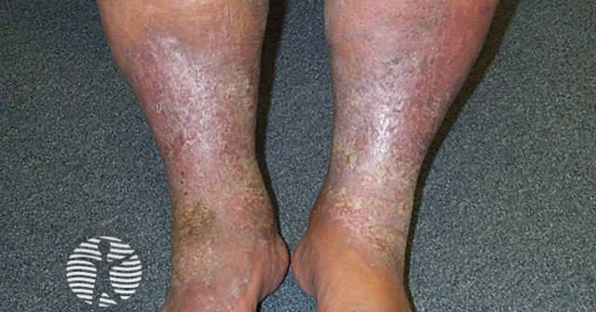 Severe lipodermatosclerosis image