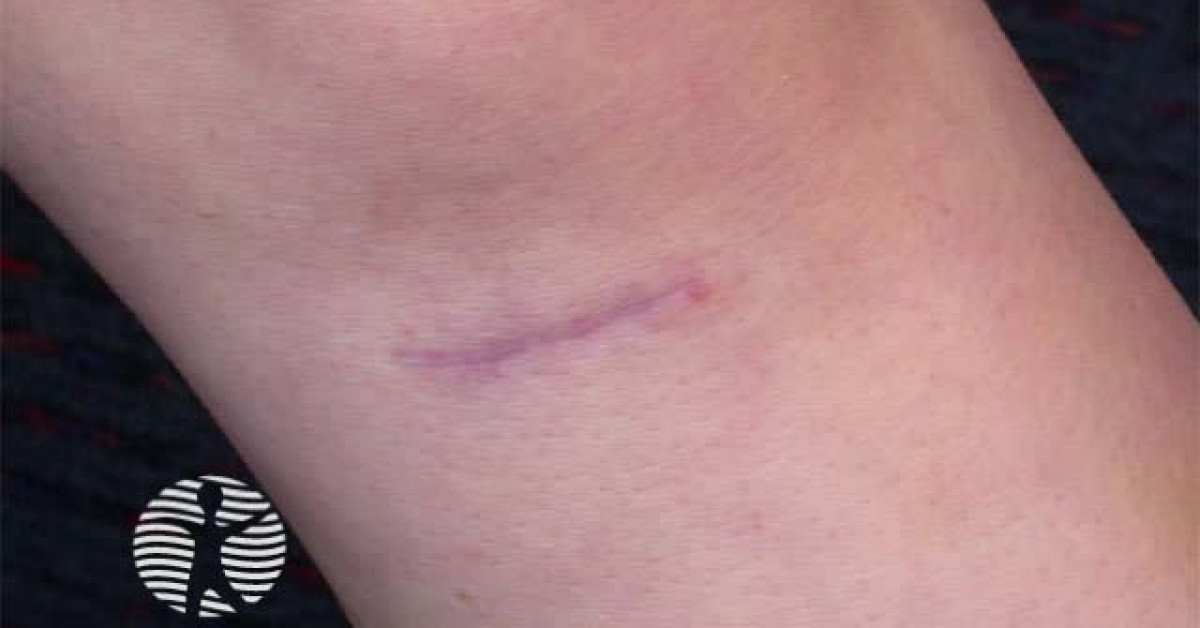 Scar granuloma image