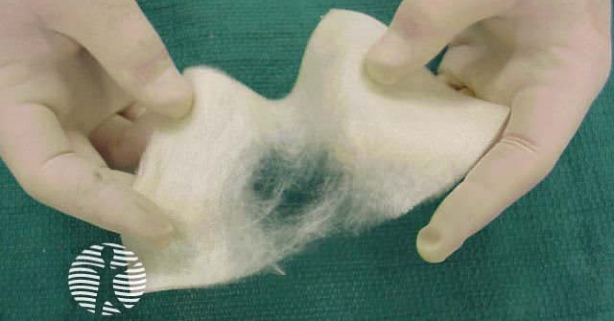 Sorbsan alginate dressing image