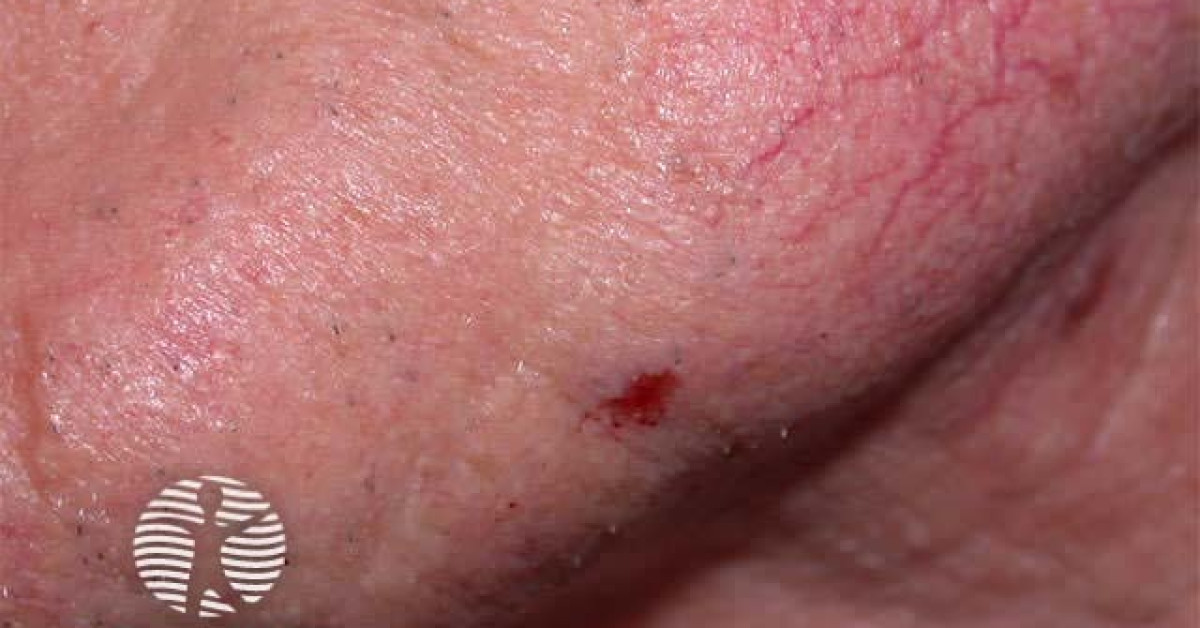 Basal cell carcinoma image