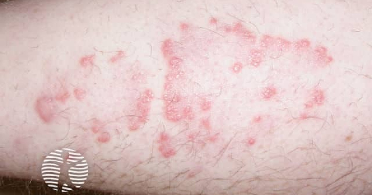 Elastosis perforans in Down syndrome image