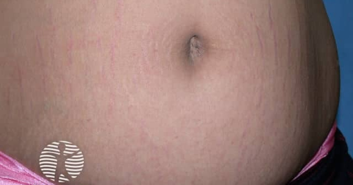 Striae atrophicae associated with obesity and Down syndrome image