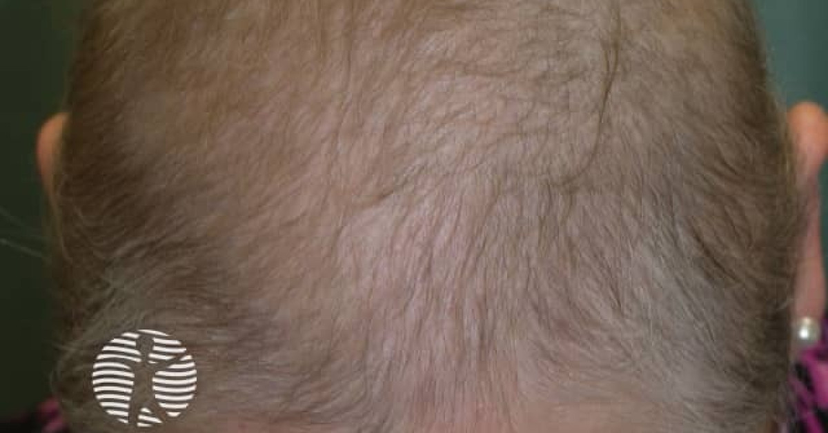 Drug Induced Alopecia Image