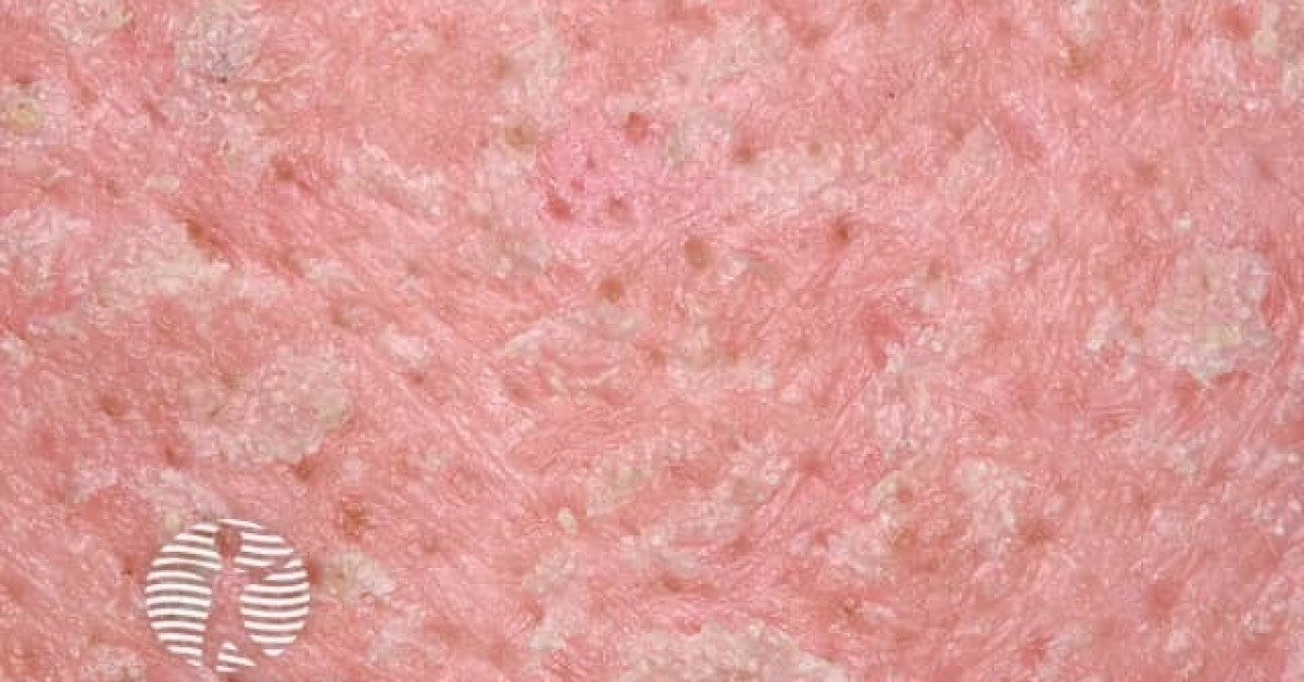 drug hypersensitivity 018 image