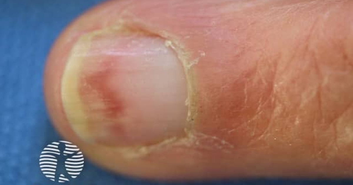 Nail dystrophy induced by hydroxyurea image