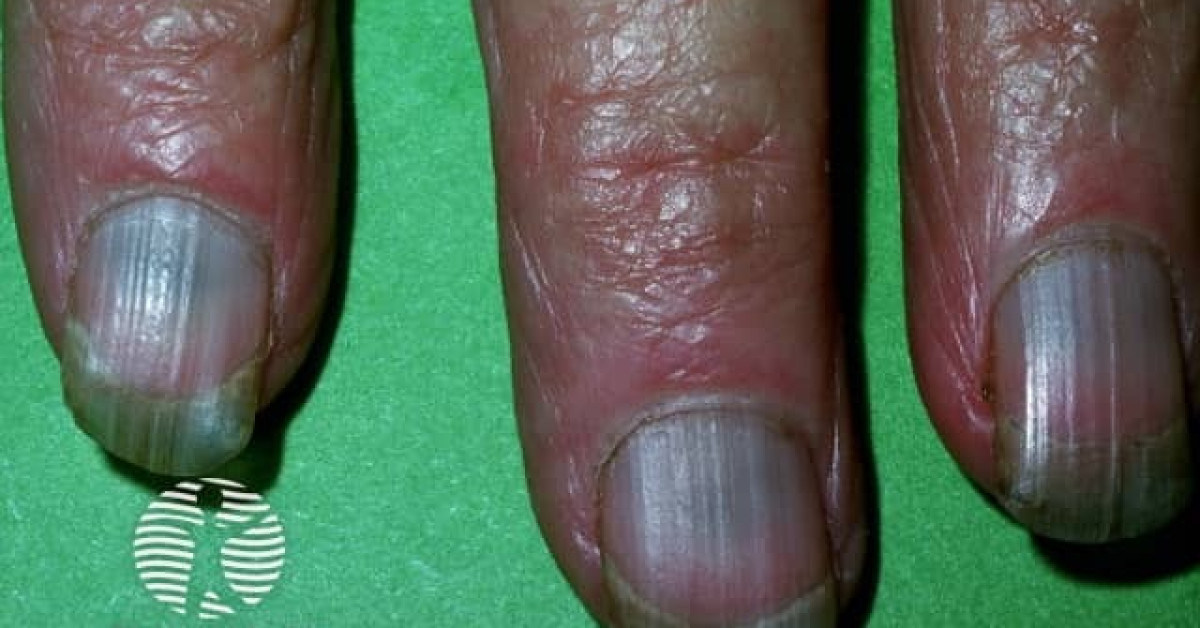 Minocycline induced nail pigmentation image