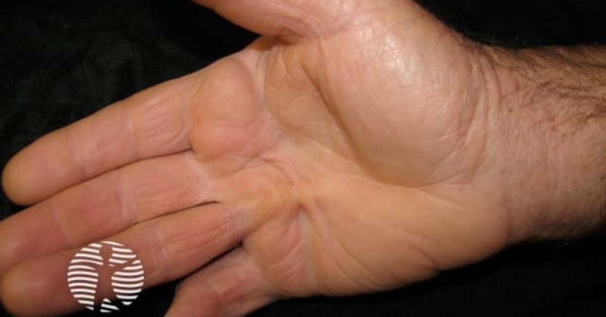 DermNet® - Dupuytren contracture 01 image