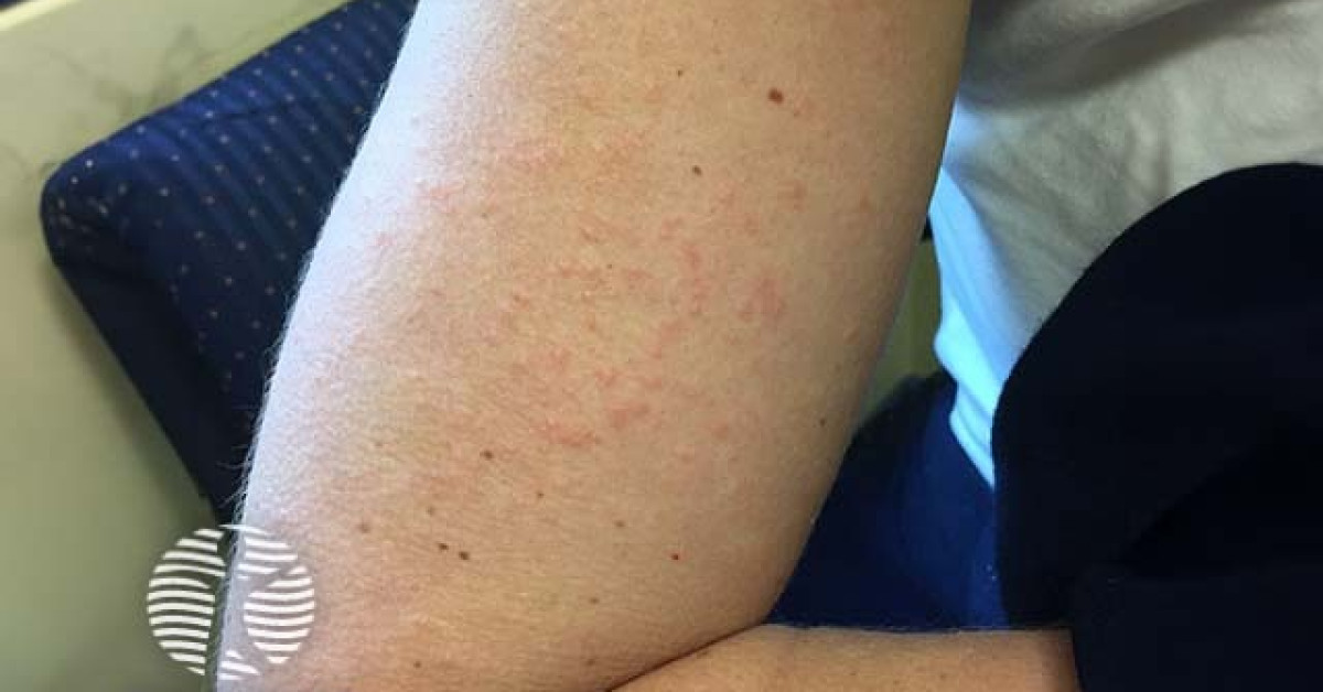 Infectious mononucleosis image