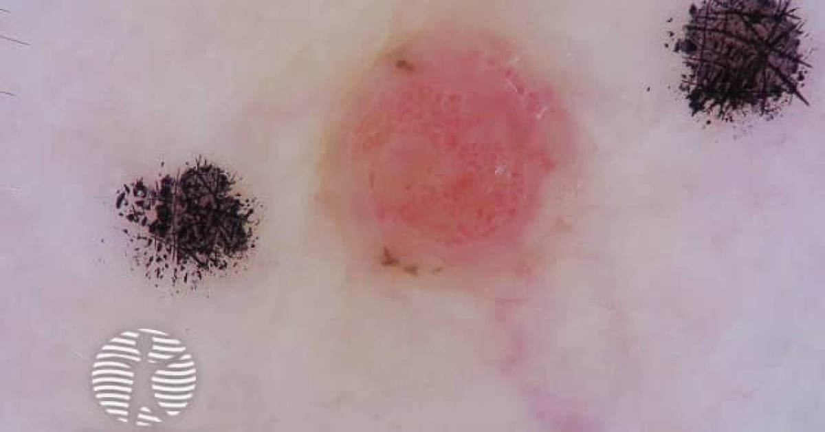 Eccrine poroma image