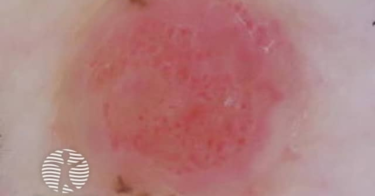 Eccrine poroma dermoscopy image