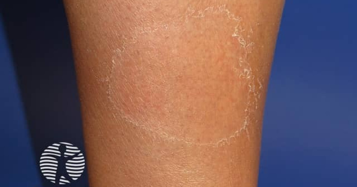 Erythema chronicum migrans image