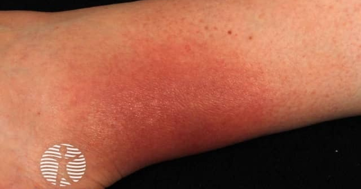 Erythema chronicum migrans image