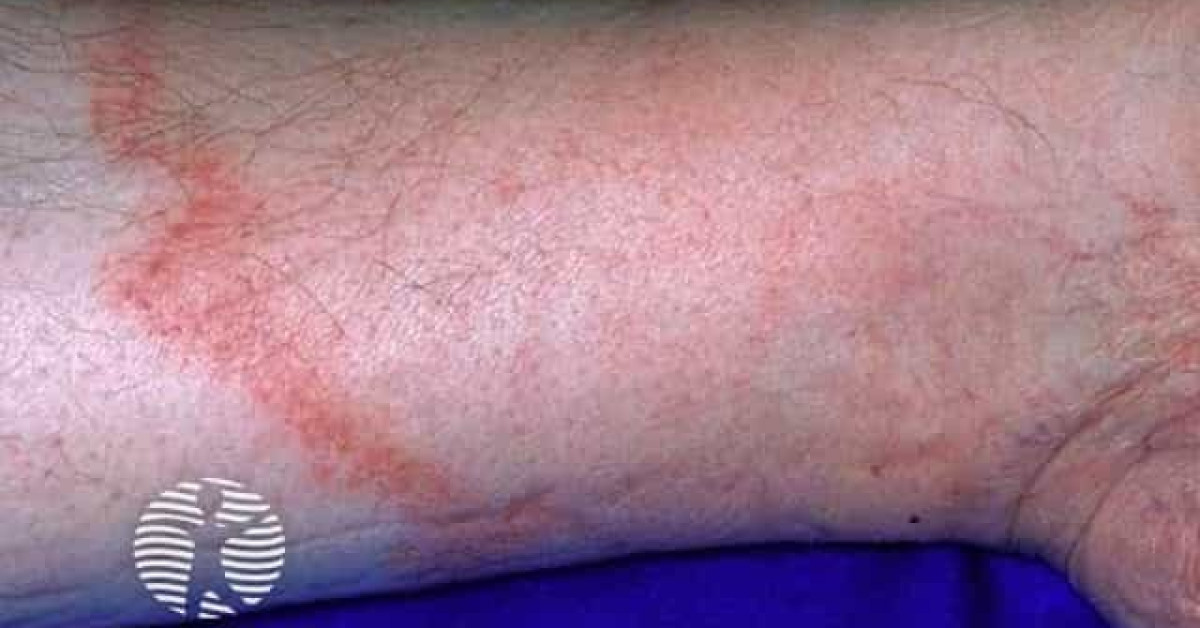 Erythema chronicum migrans image