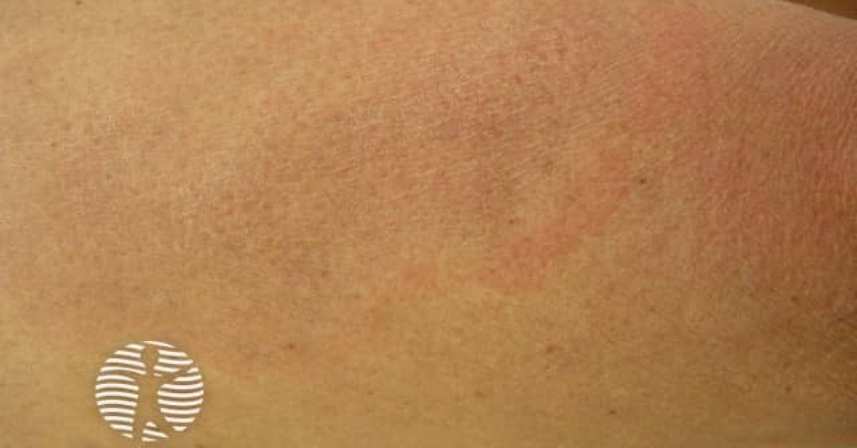 Erythema chronicum migrans image