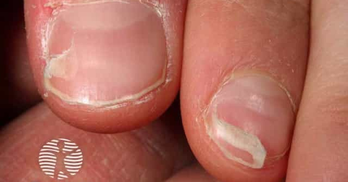 Onychomadesis due to enterovirus infection image