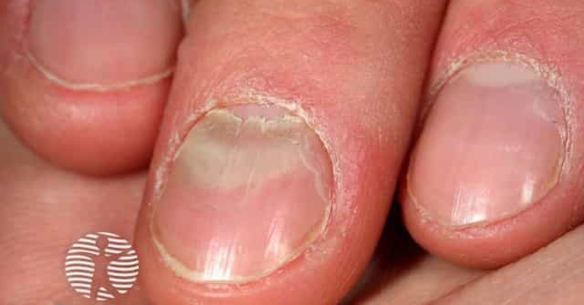 Onychomadesis due to enterovirus infection image