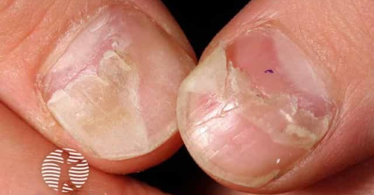 Onychomadesis due to enterovirus infection image