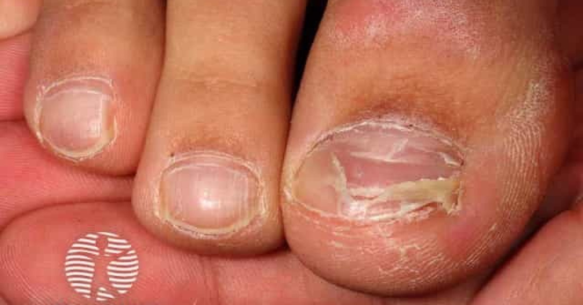 Onychomadesis due to enterovirus infection image