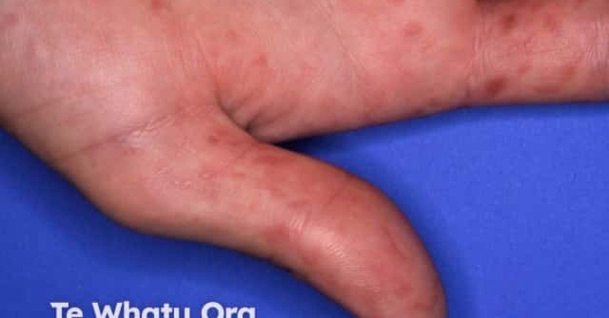 Hand foot and mouth disease image