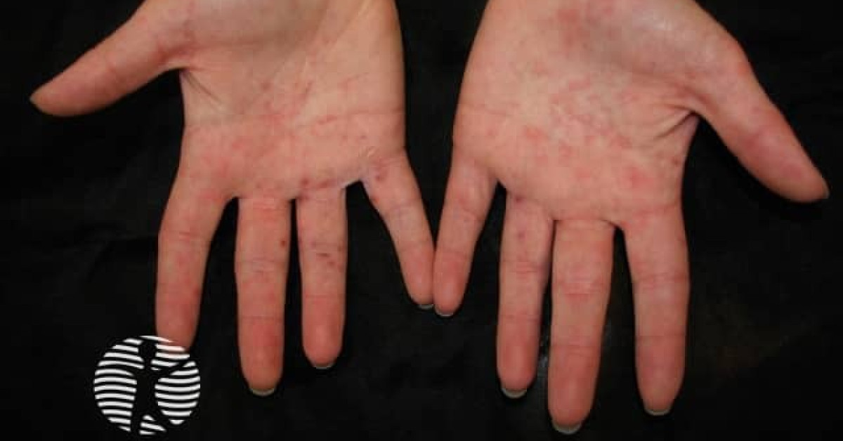 Enteroviral hand blisters image