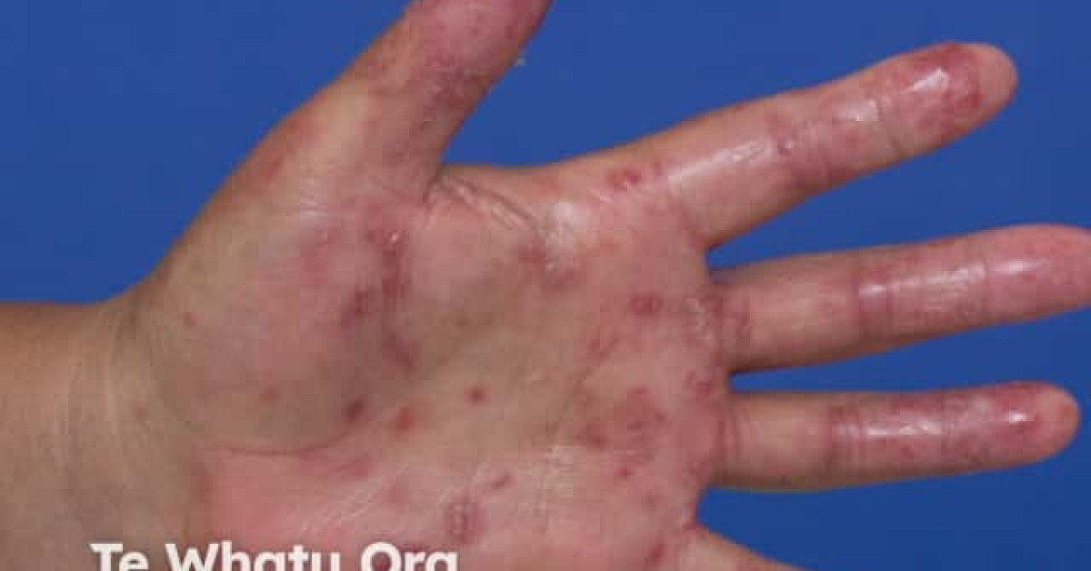 Enteroviral hand blisters image
