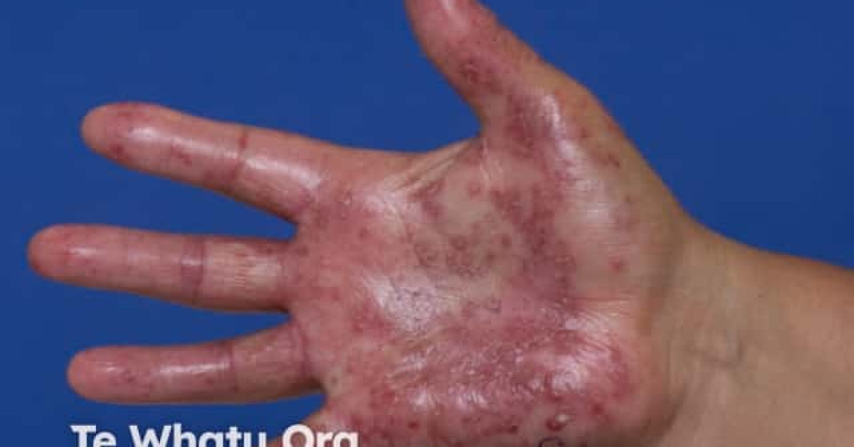 Enteroviral hand blisters image