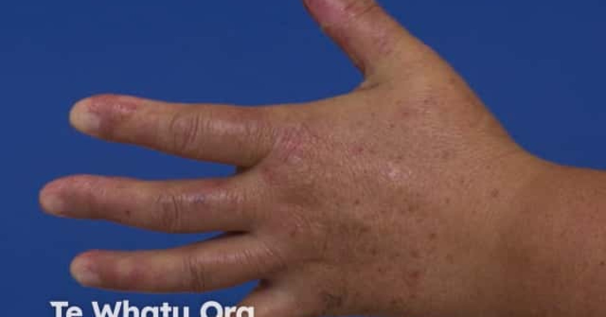 Enteroviral hand blisters image