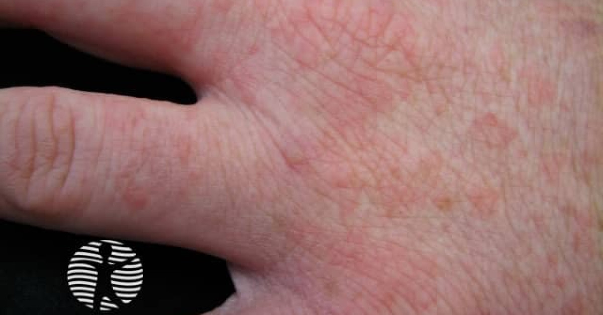 DermNet® - Enteroviral hand blisters image
