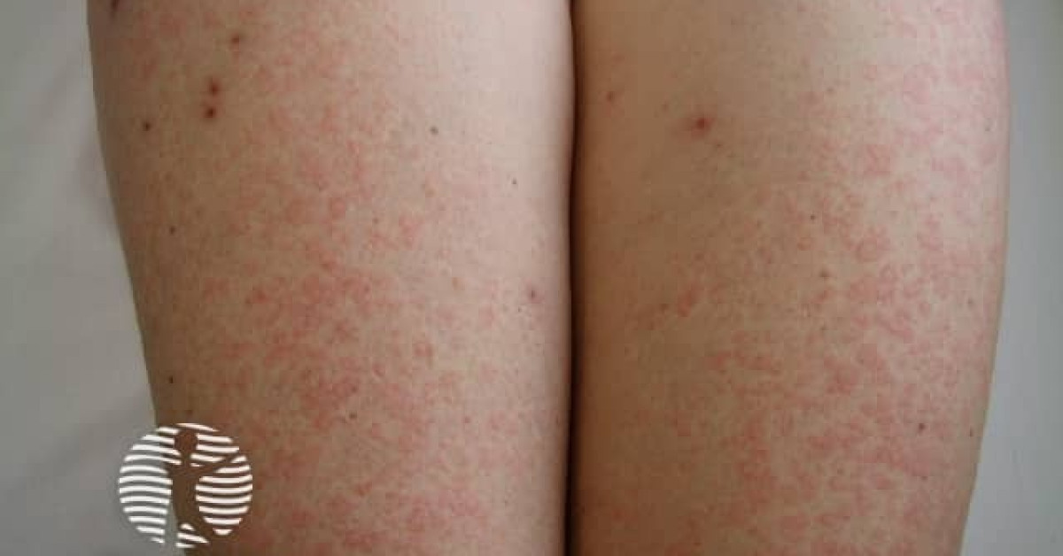 DermNet® - Enteroviral infection rash image