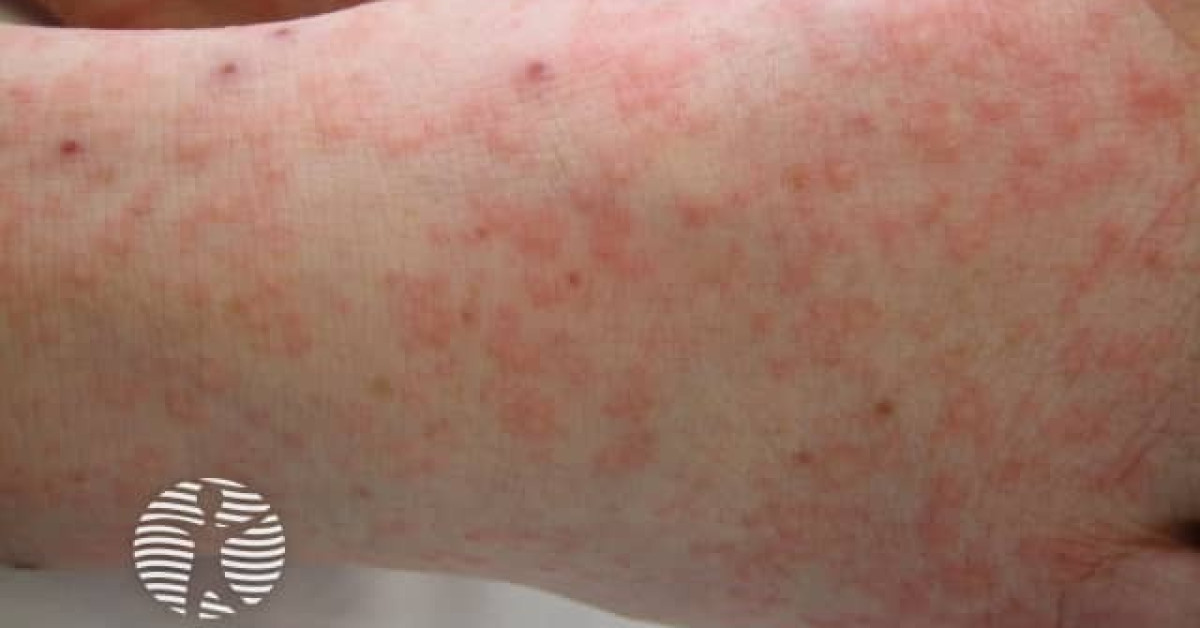 Enteroviral infection rash image