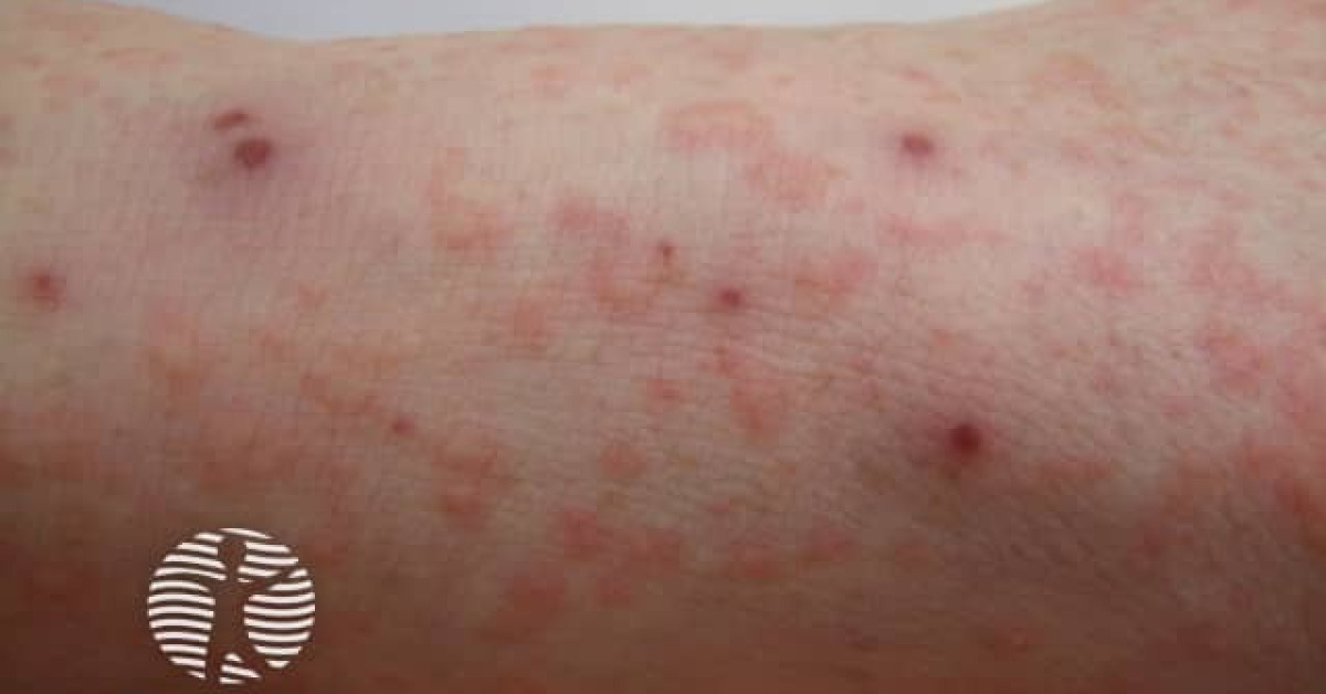 Enteroviral infection rash image