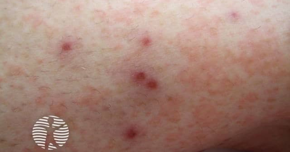 Enteroviral infection rash image