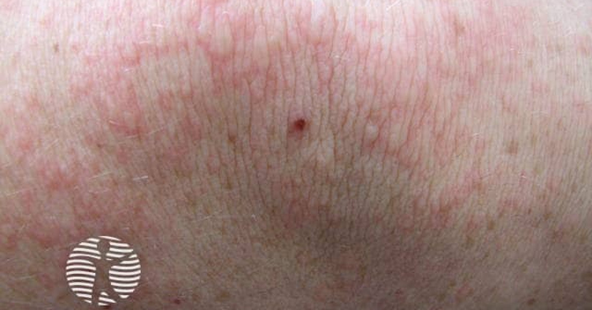 Enteroviral infection rash image