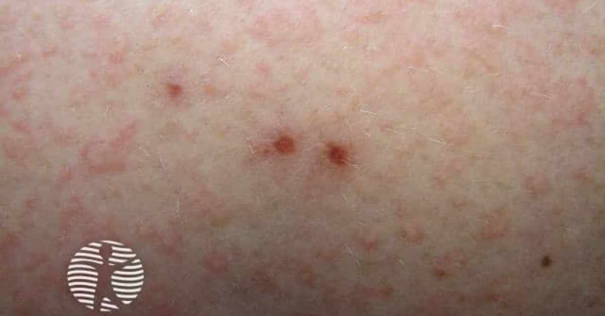 Enteroviral infection rash image