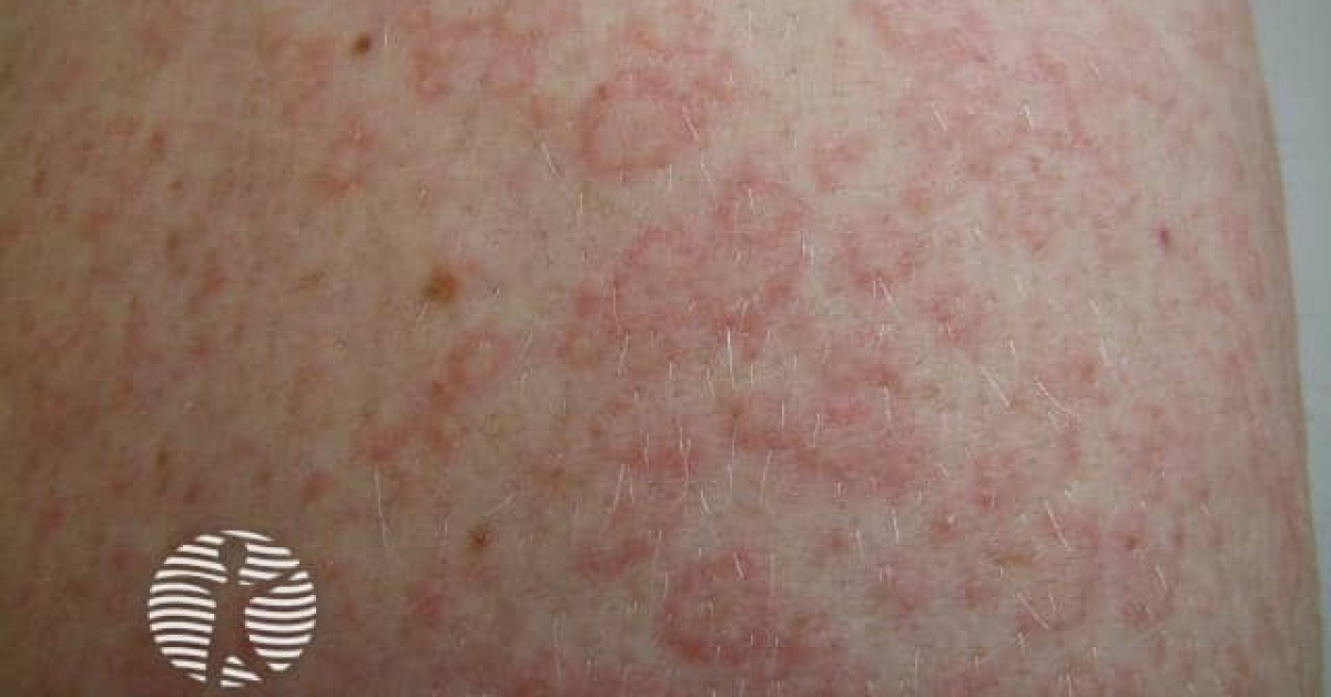 Enteroviral infection rash image