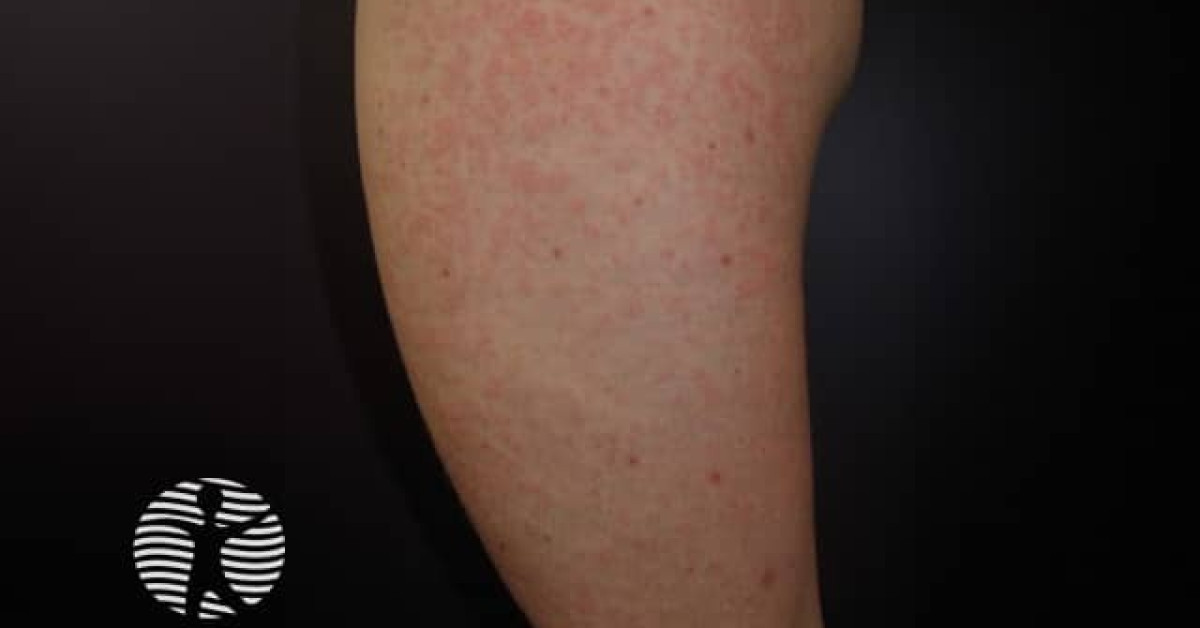 DermNet® - Enteroviral infection rash image