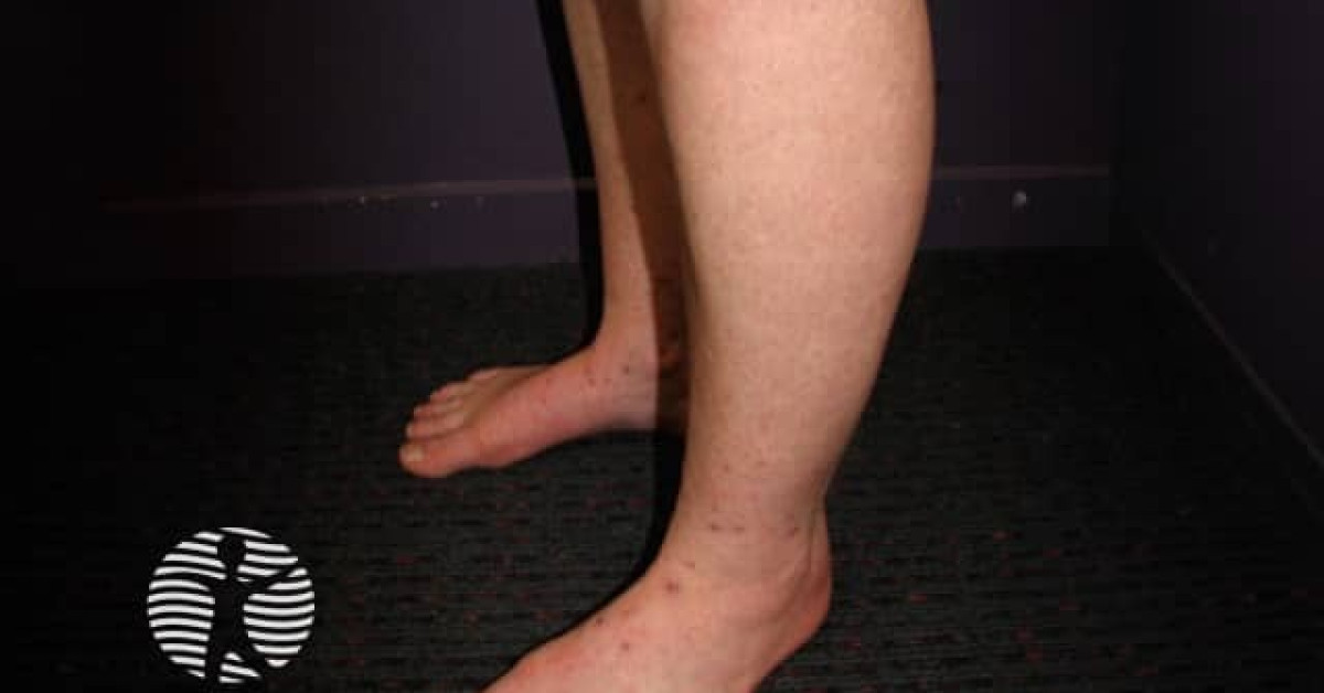 Enteroviral infection rash image