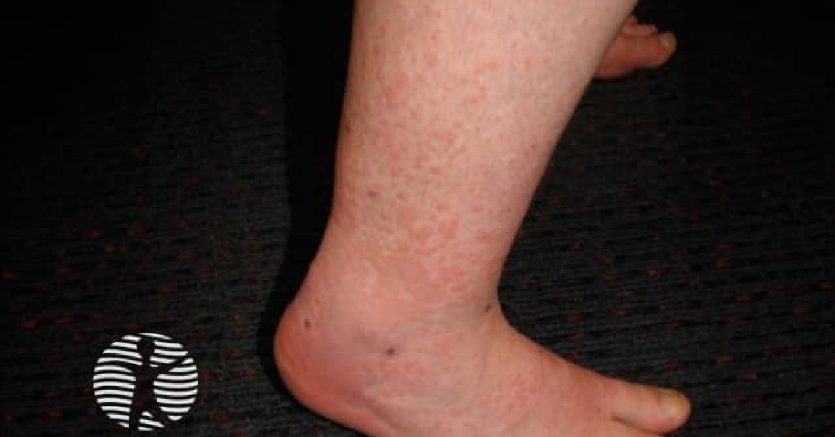Enteroviral infection rash image