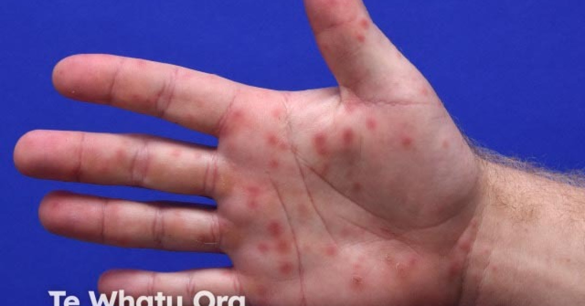 Enteroviral infection: blisters on hand image