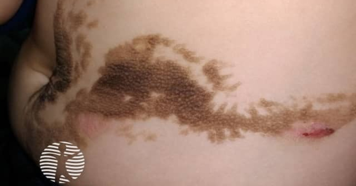 Epidermal naevus syndrome image