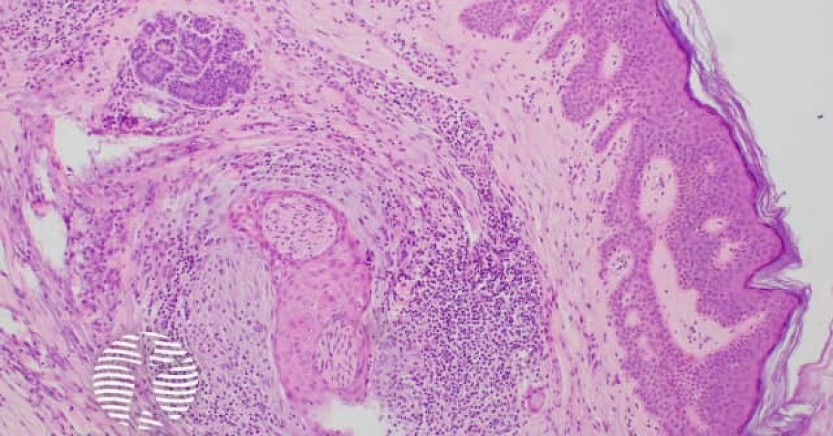 Histology of epithelial sheath neuroma image