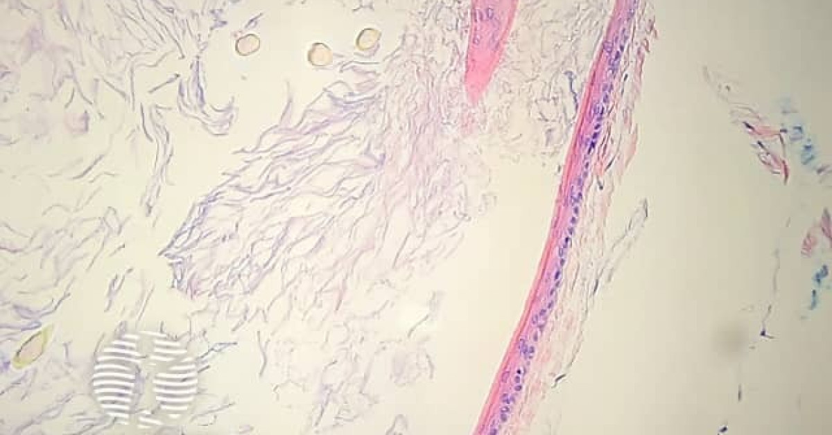 High power view of eruptive vellus cyst histopathology image