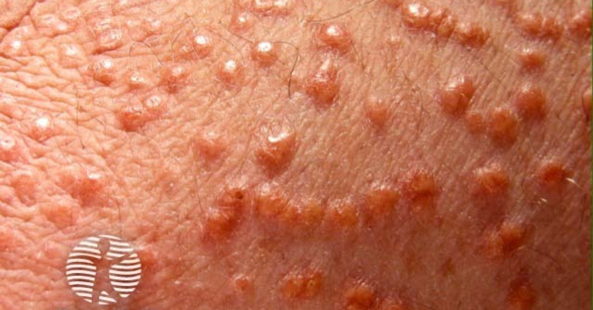 Eruptive xanthoma image